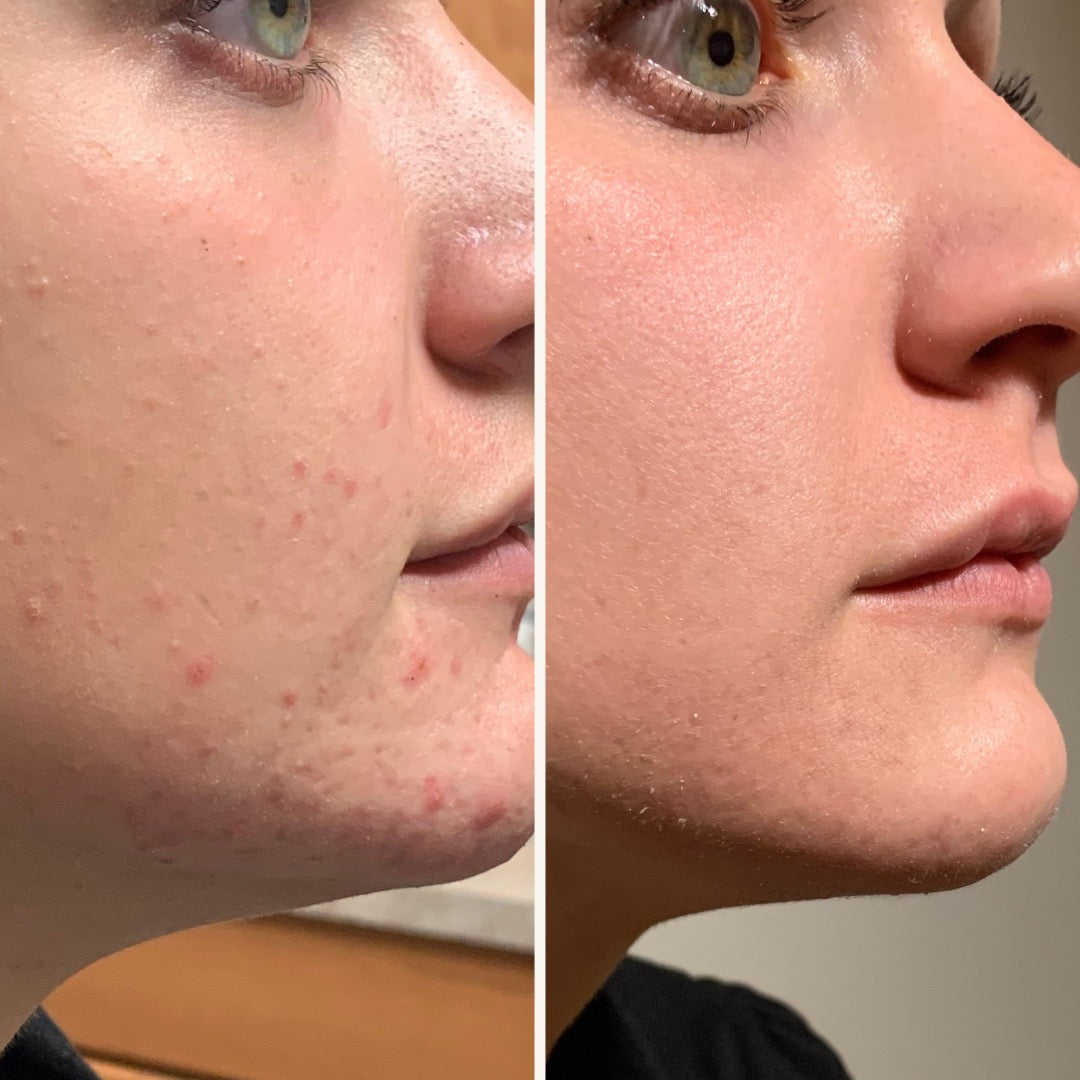 Brides – Resolu Method