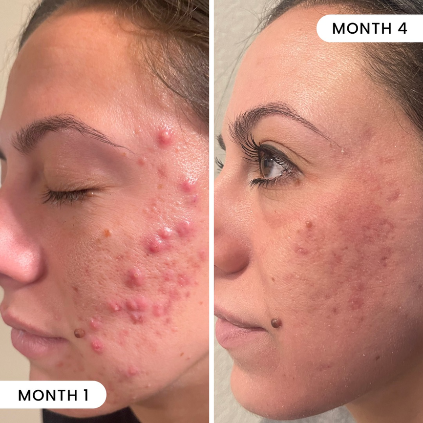 Results – Resolu Method