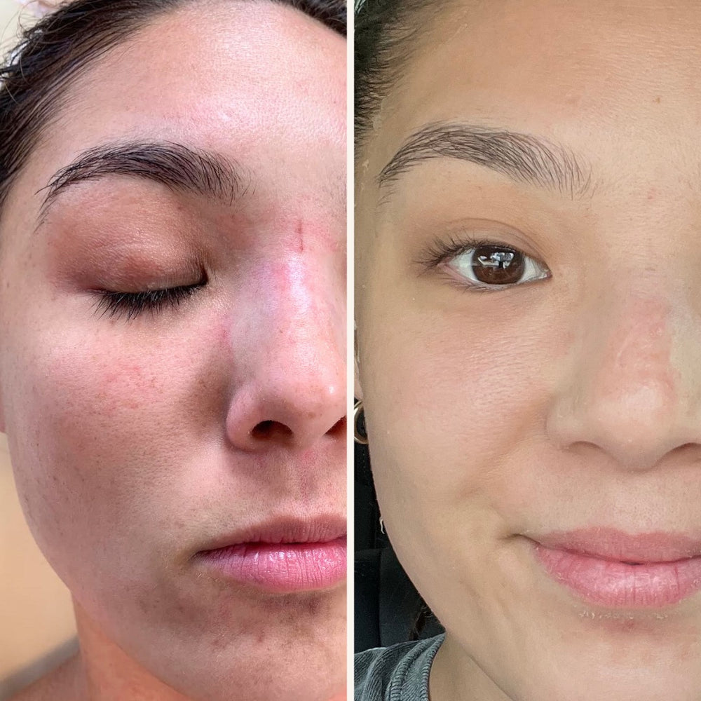 Brides – Resolu Method